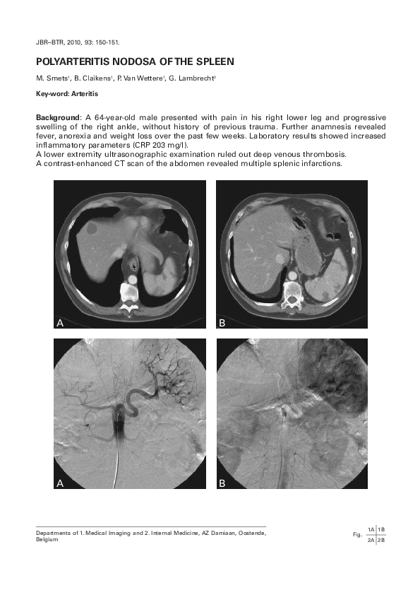 (PDF) Polyarteritis nodosa of the spleen