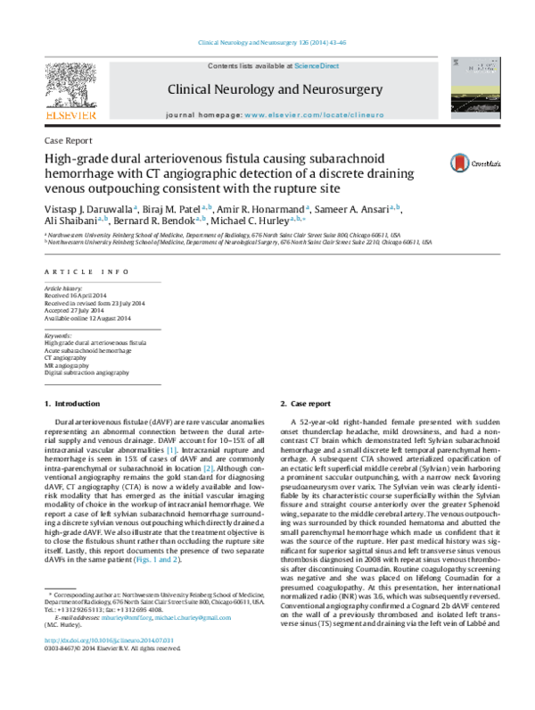 (PDF) High-grade dural arteriovenous fistula causing subarachnoid ...