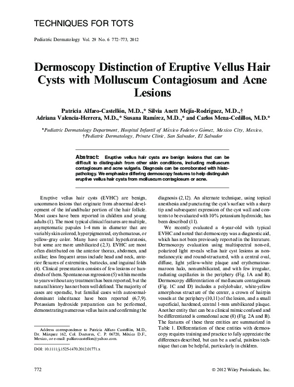 (PDF) Dermoscopy Distinction of Eruptive Vellus Hair Cysts with ...