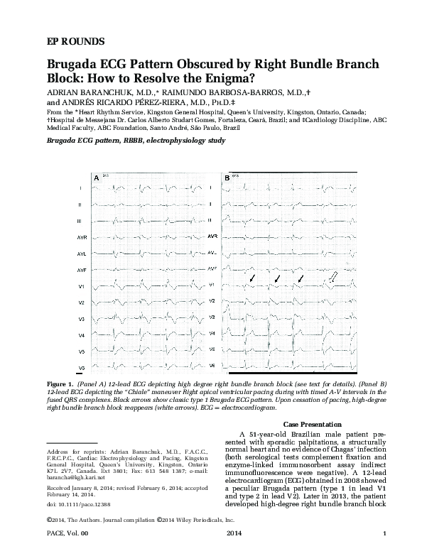 (PDF) Brugada ECG Pattern Obscured by Right Bundle Branch Block: How to ...