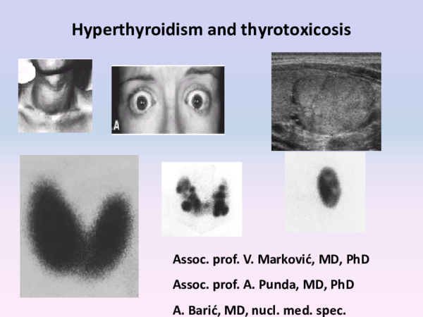 (PDF) Hyperthyroidism and Thyrotoxicosis