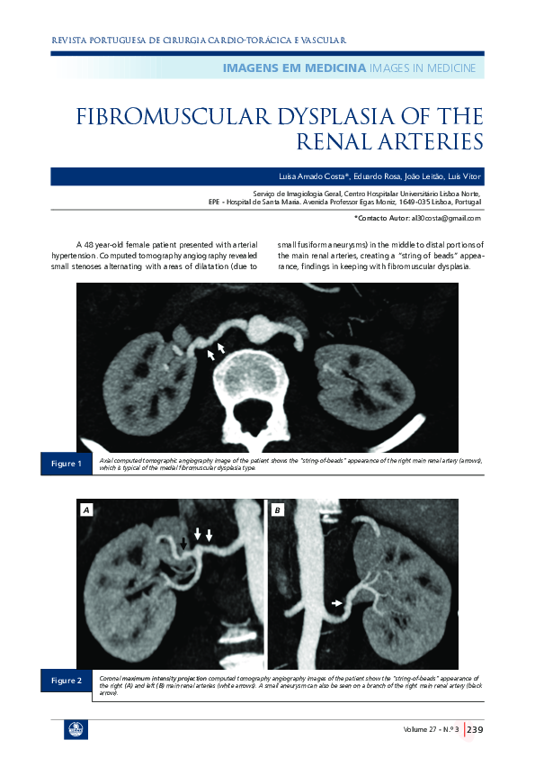 (PDF) Fibromuscular Dysplasia Of The Renal Arteries