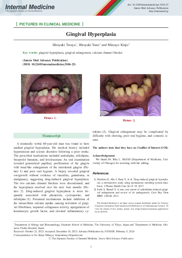 (PDF) Gingival Hyperplasia