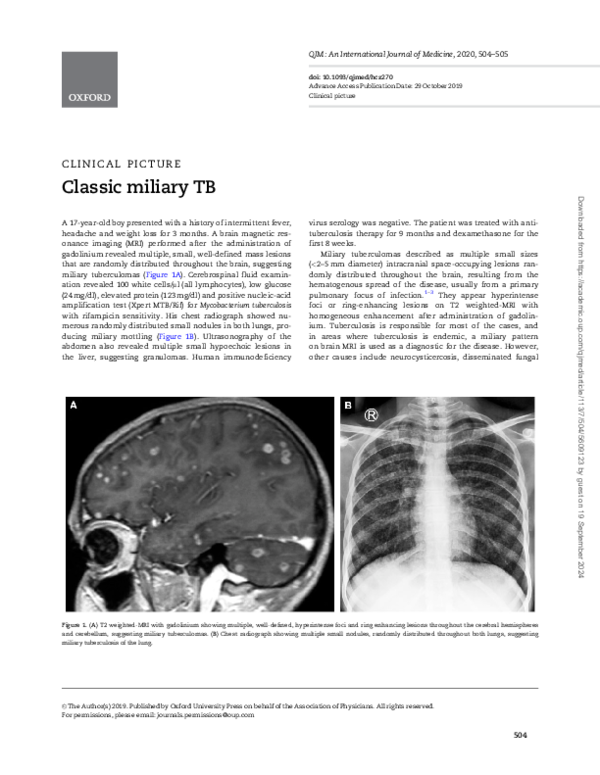 (PDF) Classic miliary TB