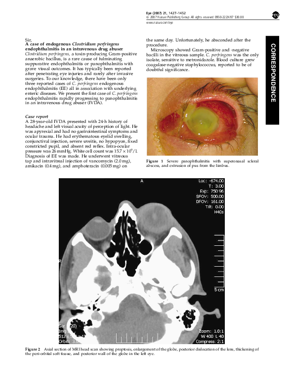 (PDF) A case of endogenous Clostridium perfringens endophthalmitis in ...