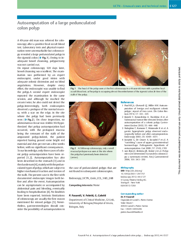 (PDF) Autoamputation of a large pedunculated colon polyp