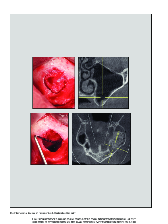 (PDF) Split-Thickness Flap for the Management of a Maxillary Sinus Wall ...