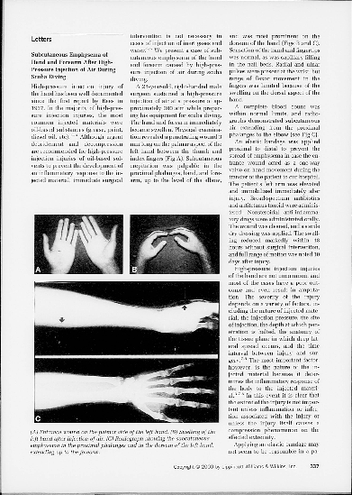 (PDF) Subcutaneous Emphysema of Hand and Forearm After High-Pressure ...