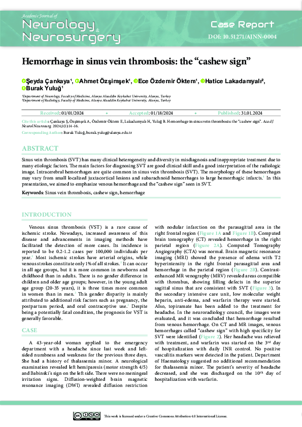 (PDF) Hemorrhage in sinus vein thrombosis: the "cashew sign