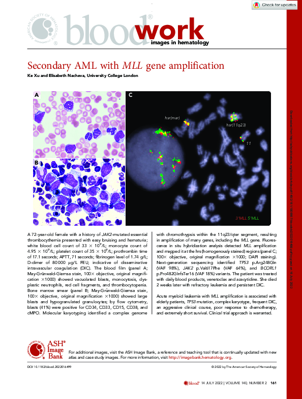 (PDF) Secondary AML with MLL gene amplification