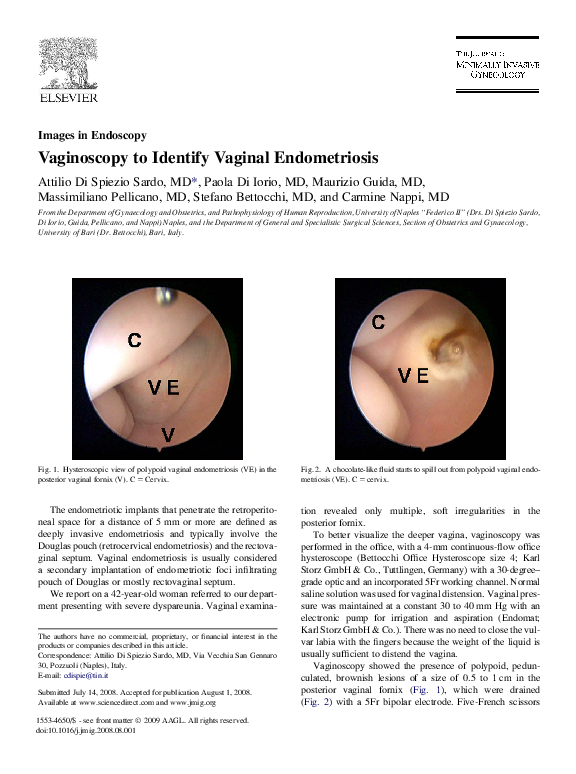 (PDF) Vaginoscopy to Identify Vaginal Endometriosis