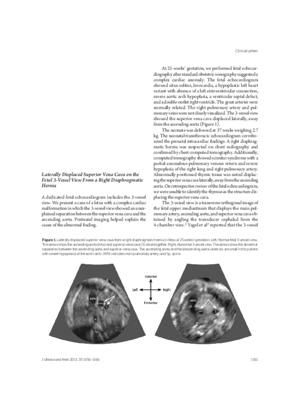 (PDF) Laterally Displaced Superior Vena Cava on the Fetal 3-Vessel View ...