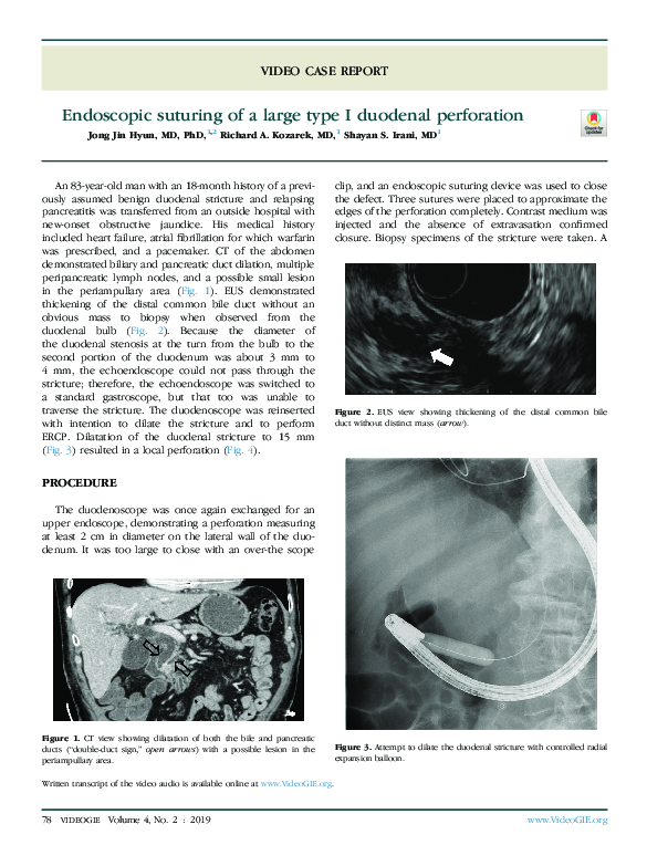 (PDF) Endoscopic suturing of a large type I duodenal perforation