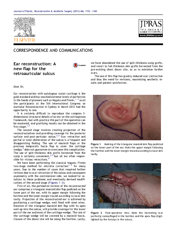 (PDF) Ear reconstruction: A new flap for the retroauricular sulcus