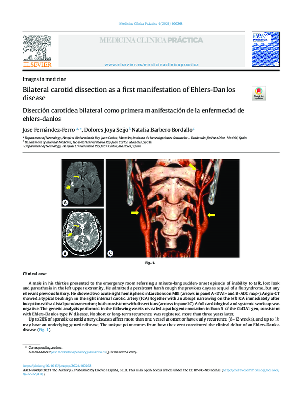 (PDF) Bilateral carotid dissection as a first manifestation of Ehlers ...