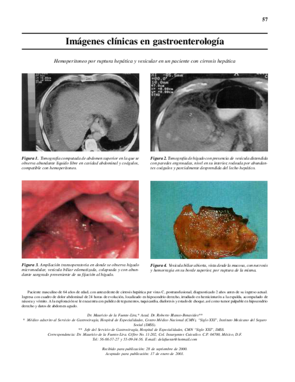 (PDF) Hemoperitoneo por ruptura hepática y vesicular en un paciente con ...