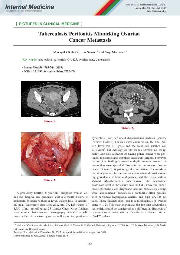 (PDF) Tuberculosis Peritonitis Mimicking Ovarian Cancer Metastasis