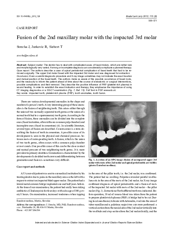 (PDF) Fusion of the 2nd maxillary molar with the impacted 3rd molar