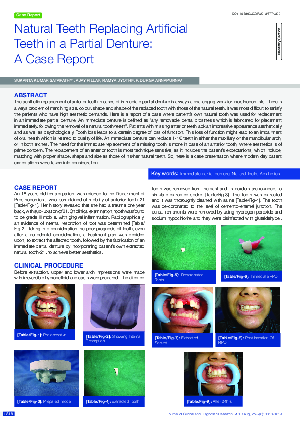 (PDF) Natural teeth replacing artificial teeth in a partial denture: a ...