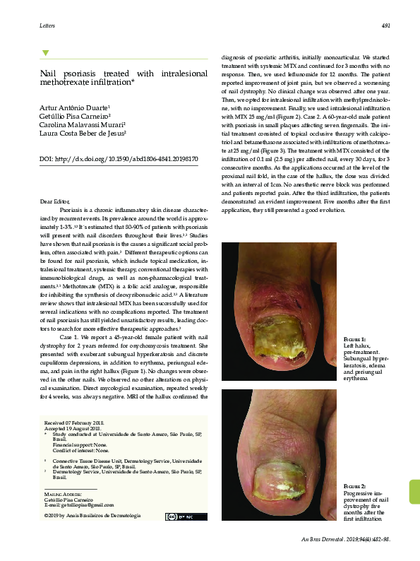 (PDF) Nail psoriasis treated with intralesional methotrexate infiltration