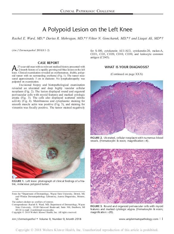 (PDF) A Polypoid Lesion on the Left Knee