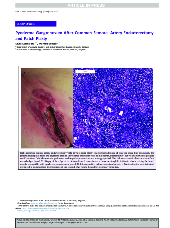 (PDF) Pyoderma Gangrenosum After Common Femoral Artery Endarterectomy and Patch Plasty