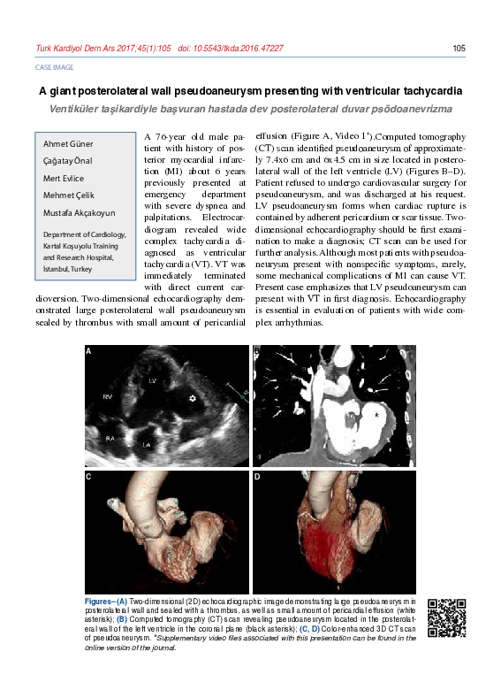 (PDF) A giant posterolateral wall pseudoaneurysm presented with ...