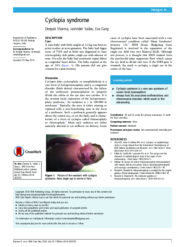 (PDF) Rare Case of Cyclopia Syndrome in Newborn