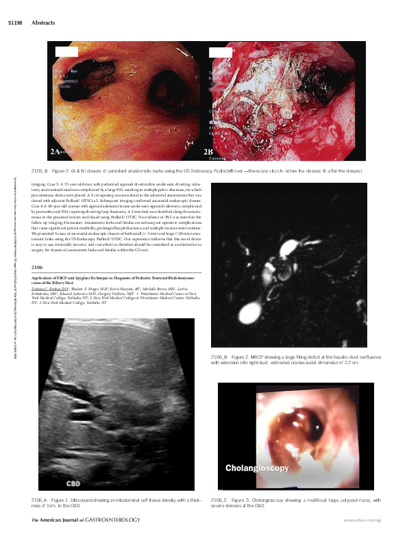 (PDF) Application of ERCP and Spyglass Technique in Diagnosis of ...