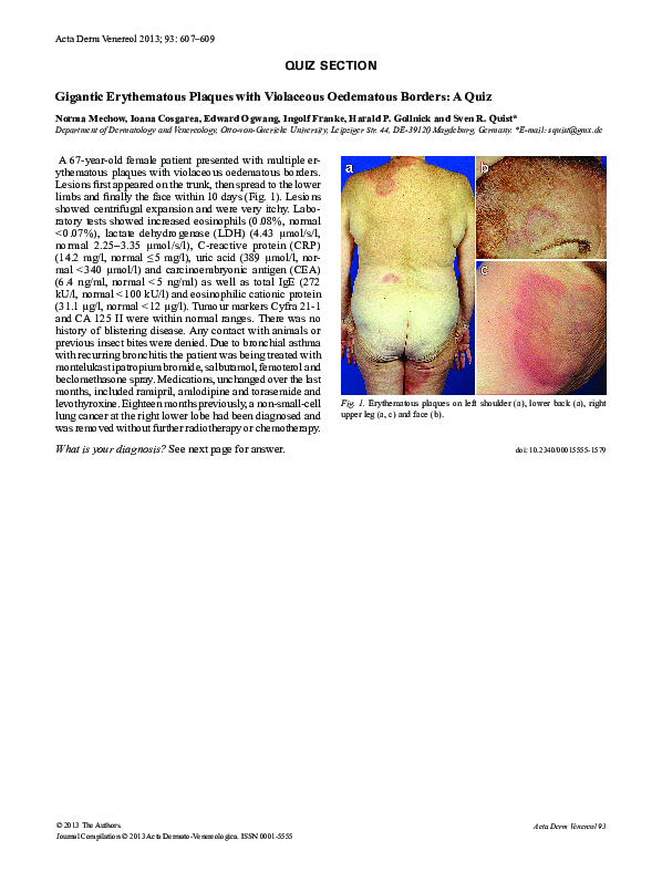 (PDF) Gigantic Erythematous Plaques with Violaceous Oedematous Borders ...