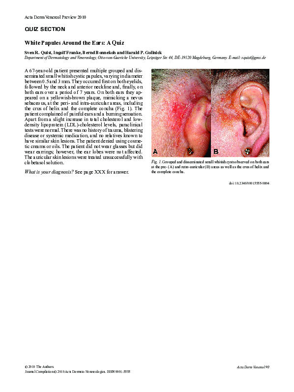 (PDF) White Papules Around the Ears: A Quiz