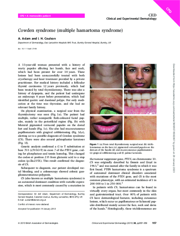 (PDF) Cowden syndrome (multiple hamartoma syndrome)