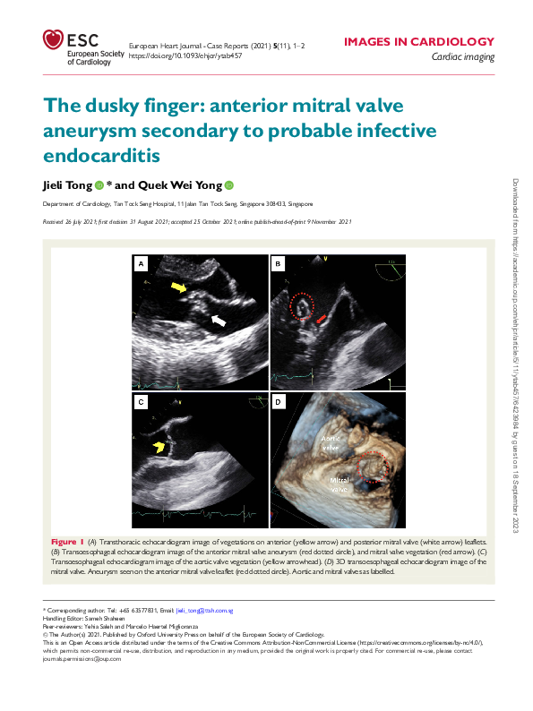 (PDF) The dusky finger: anterior mitral valve aneurysm secondary to ...