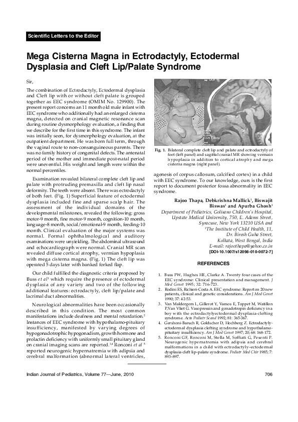 (PDF) Mega cisterna magna in ectrodactyly, ectodermal dysplasia and ...