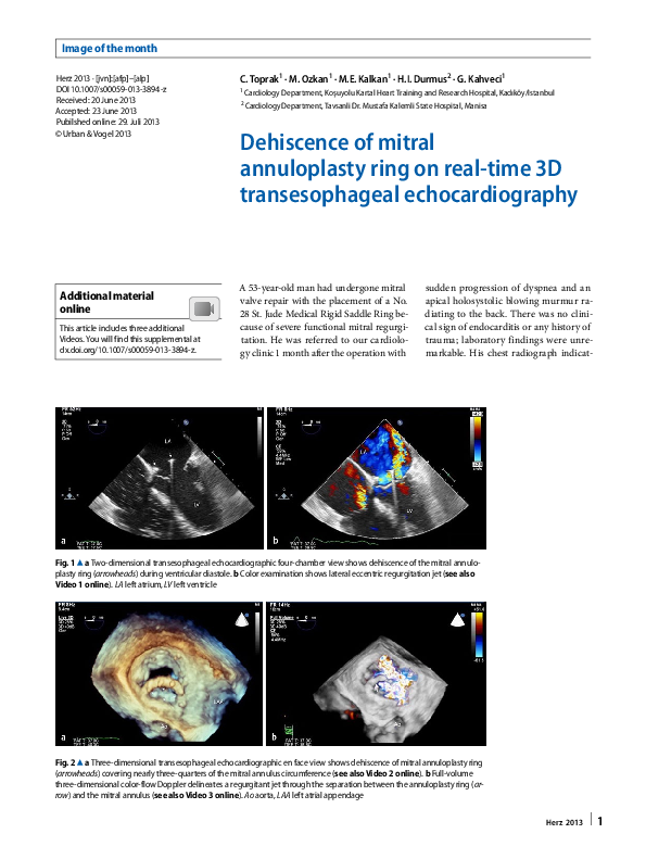 (PDF) Dehiscence of mitral annuloplasty ring on real-time 3D ...