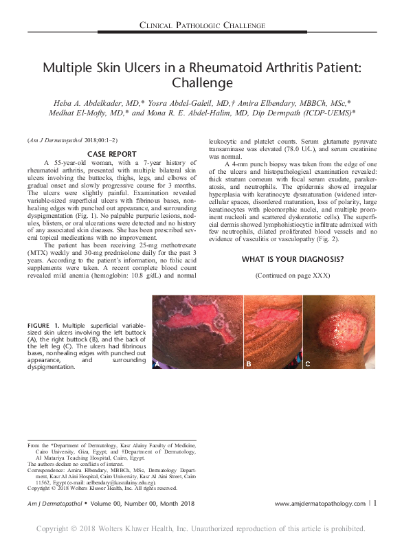 (PDF) Multiple Skin Ulcers in a Rheumatoid Arthritis Patient