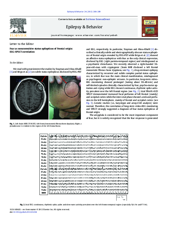(PDF) Fear as nonconvulsive status epilepticus of frontal origin: EEG ...