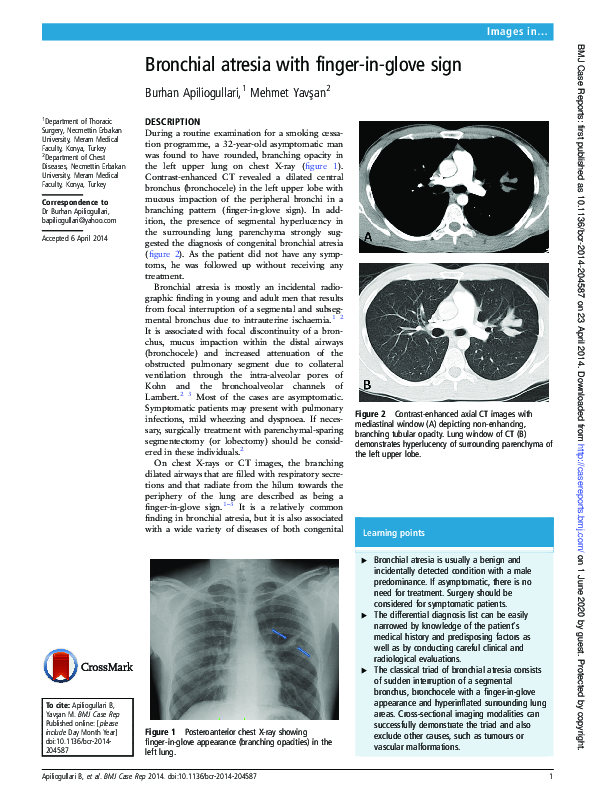 (PDF) Bronchial atresia with finger-in-glove sign