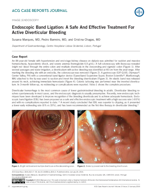 (PDF) Endoscopic Band Ligation: A Safe And Effective Treatment For Active Diverticular Bleeding ...