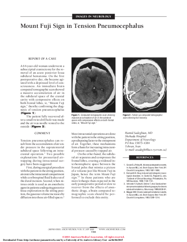 (PDF) Mount Fuji Sign in tension pneumocephalus