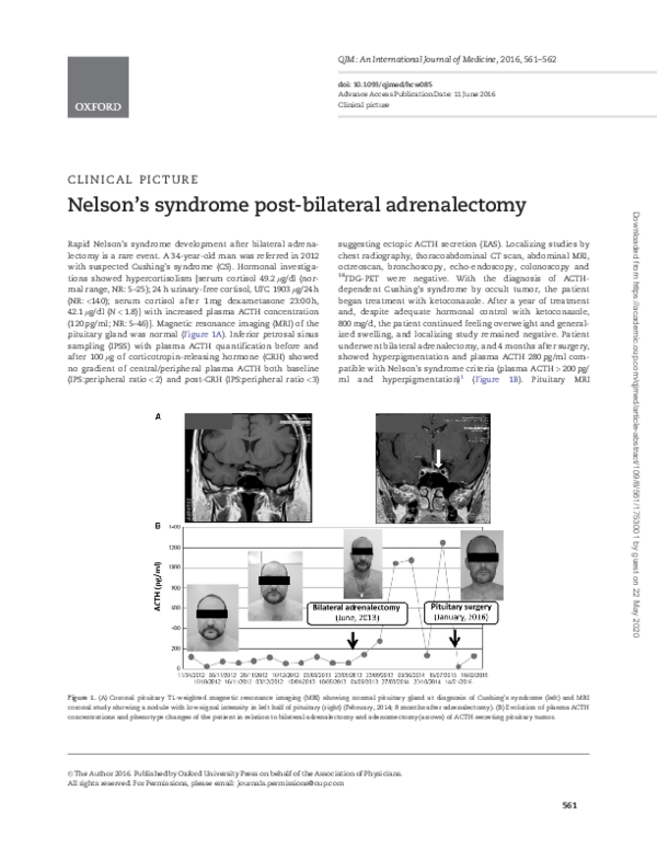 (PDF) Nelson's syndrome post bilateral adrenalectomy