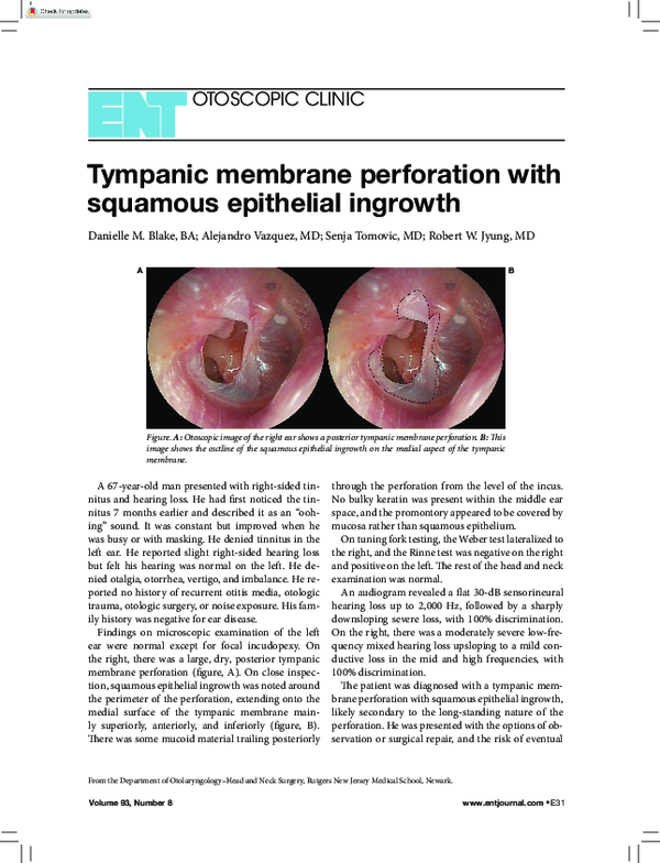 (PDF) Tympanic Membrane Perforation with Squamous Epithelial Ingrowth