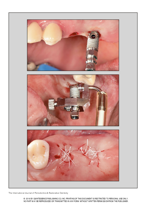 (PDF) The Feasibility of Flapless Approach to Sinus Augmentation Using ...