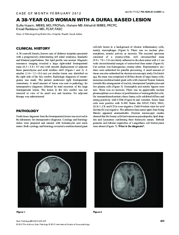 (PDF) A 38-YEAR Old Woman with a Dural Based Lesion