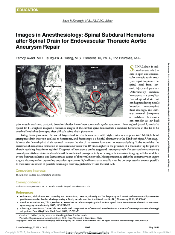 (PDF) Spinal Subdural Hematoma after Spinal Drain for Endovascular ...