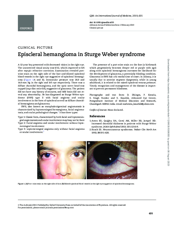 (PDF) Episcleral hemangioma in Sturge Weber syndrome | Sushmita Kaushik - Academia.edu