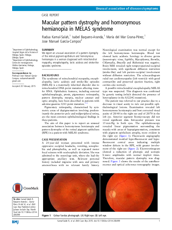 (PDF) Macular pattern dystrophy and homonymous hemianopia in MELAS syndrome
