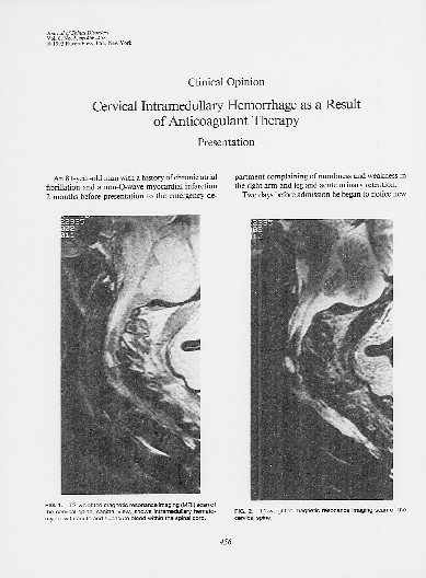 (PDF) Cervical intramedullary hemorrhage as a result of anticoagulant ...