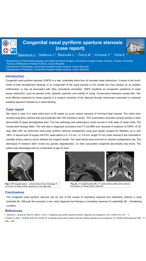 (PDF) Congenital nasal pyriform aperture stenosis