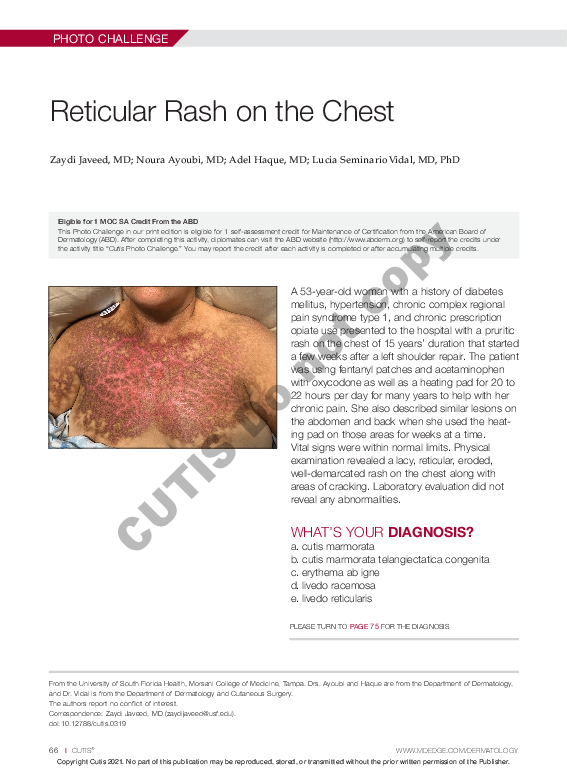 (PDF) Reticular Rash on the Chest | Adel Haque - Academia.edu